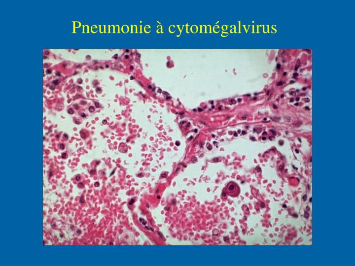 PPT - Pathologie inflammatoire I Inflammation aiguë PowerPoint ...