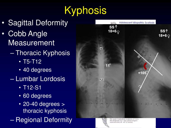 PPT - Spinal Deformity and Degeneration PowerPoint Presentation - ID:244232
