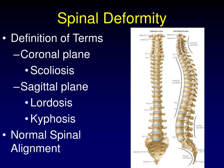 PPT - Spinal Deformity and Degeneration PowerPoint Presentation - ID:244232