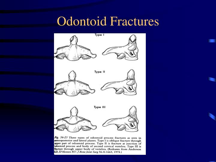 PPT - Cervical Spine Injuries Classification and Non-operative ...