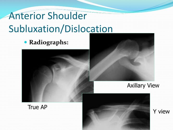 PPT - THE SHOULDER: Evaluation and Treatment of Common Injuries ...