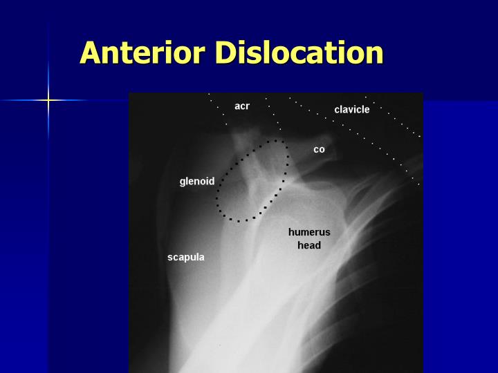 PPT - COMMON SHOULDER PROBLEMS PowerPoint Presentation - ID:245881