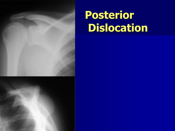 PPT - COMMON SHOULDER PROBLEMS PowerPoint Presentation - ID:245881