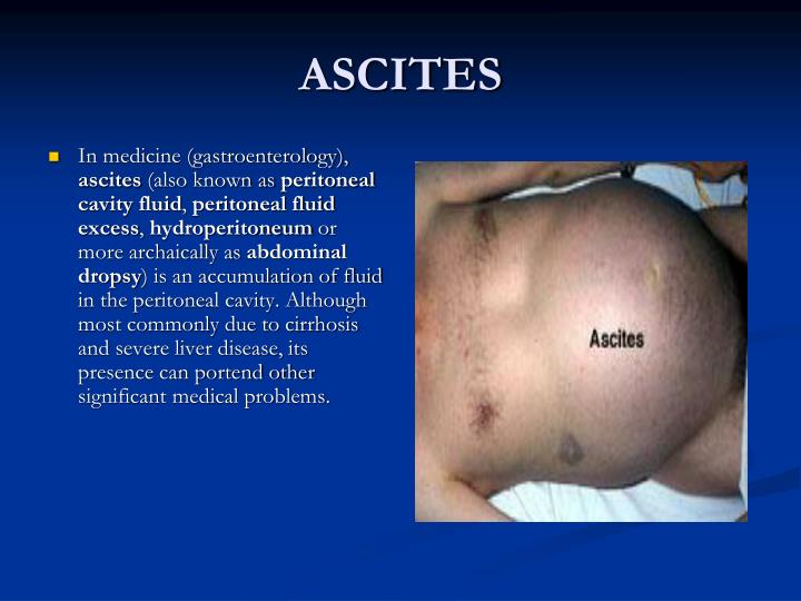 PPT - LeVeen or Denver Shunt Patency PowerPoint Presentation - ID:248170