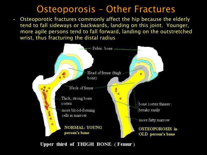 PPT - Osteoporosis PowerPoint Presentation - ID:248494