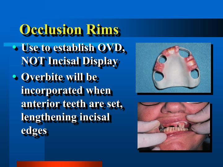 PPT - Single Complete Dentures PowerPoint Presentation - ID:248925