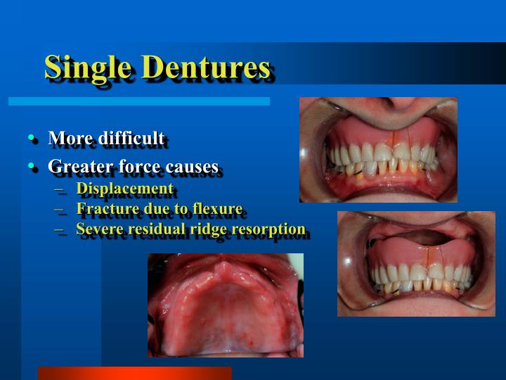 PPT - Single Complete Dentures PowerPoint Presentation - ID:248925