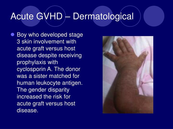 PPT - Graft Versus Host Disease PowerPoint Presentation - ID:249820
