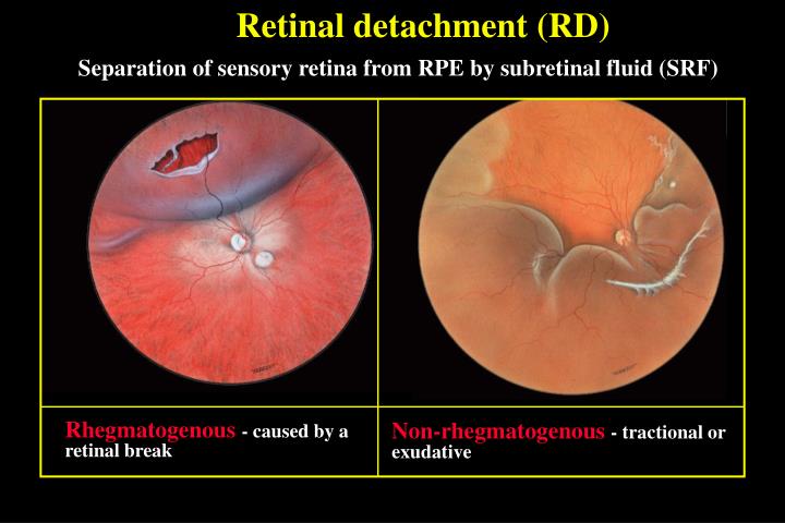 PPT - INTRODUCTION TO RETINAL DETACHMENT (RD) PowerPoint Presentation ...