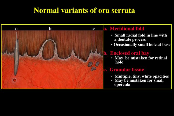 PPT - INTRODUCTION TO RETINAL DETACHMENT (RD) PowerPoint Presentation ...