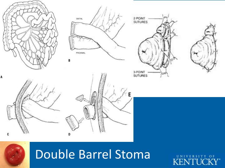 PPT - The Difficult Stoma PowerPoint Presentation - ID:257323
