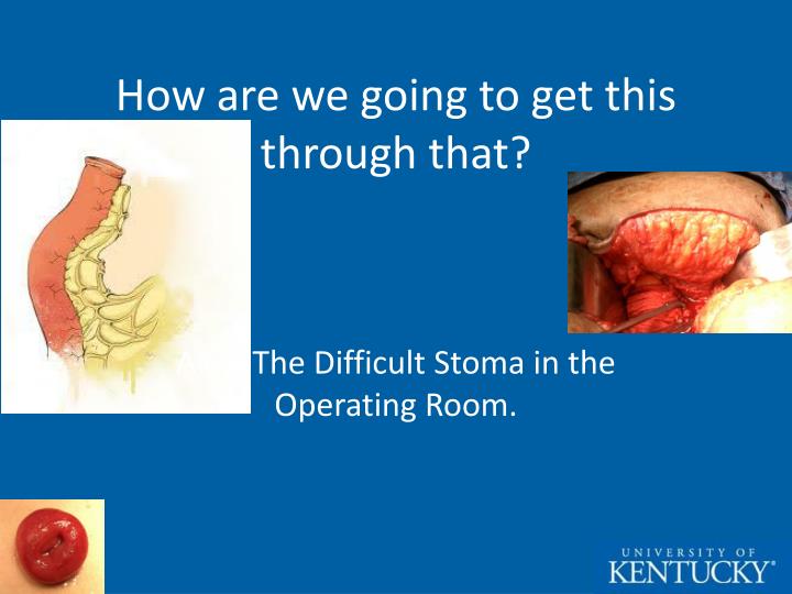 PPT - The Difficult Stoma PowerPoint Presentation - ID:257323