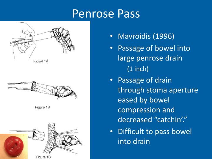 PPT - The Difficult Stoma PowerPoint Presentation - ID:257323