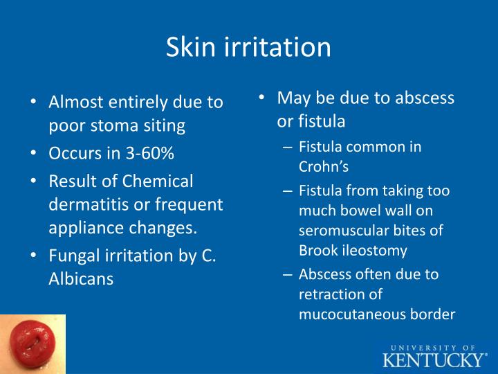 PPT - The Difficult Stoma PowerPoint Presentation - ID:257323