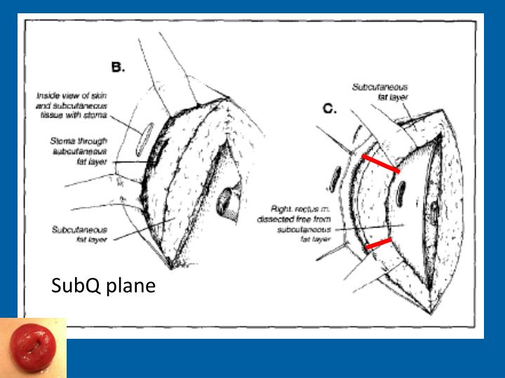 PPT - The Difficult Stoma PowerPoint Presentation - ID:257323
