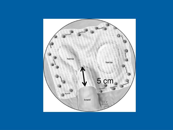 PPT - The Difficult Stoma PowerPoint Presentation - ID:257323
