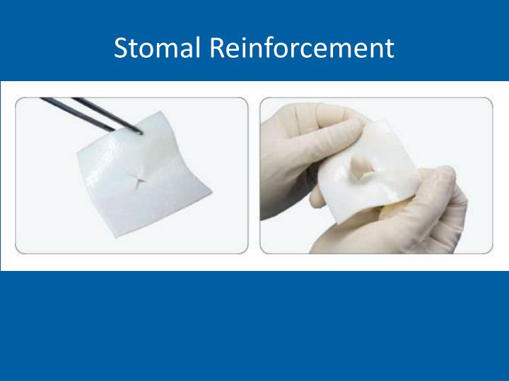 PPT - The Difficult Stoma PowerPoint Presentation - ID:257323