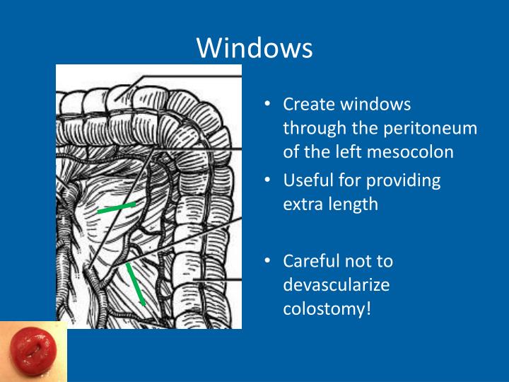 PPT - The Difficult Stoma PowerPoint Presentation - ID:257323