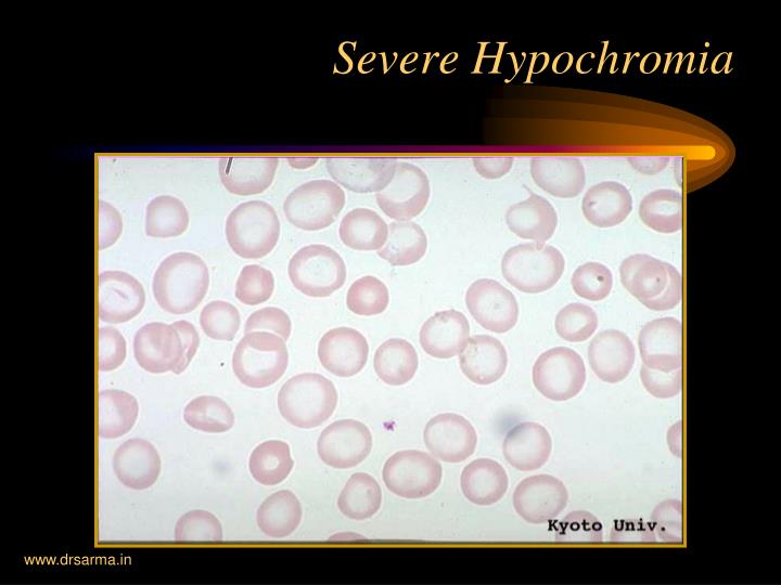 PPT - A Practical Approach to Anemia PowerPoint Presentation - ID:259255