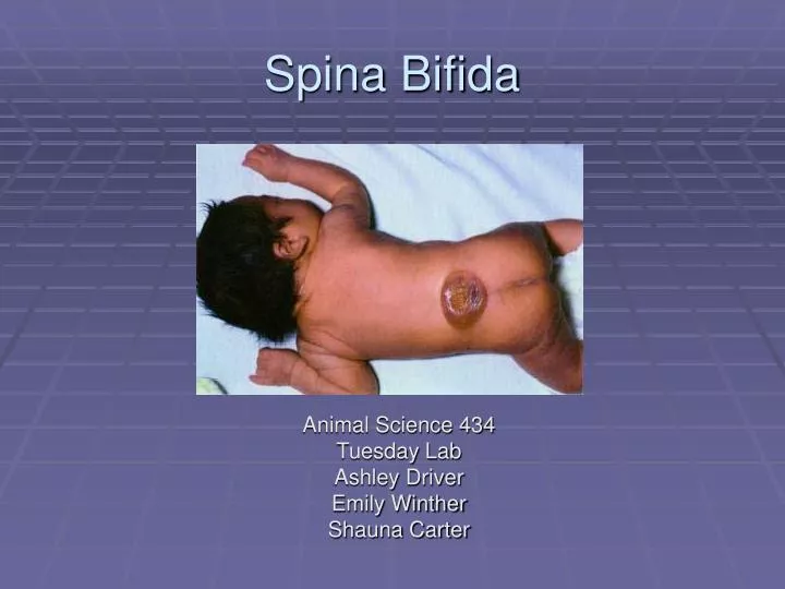 Ppt Spina Bifida Powerpoint Presentation Free Download Id 259707