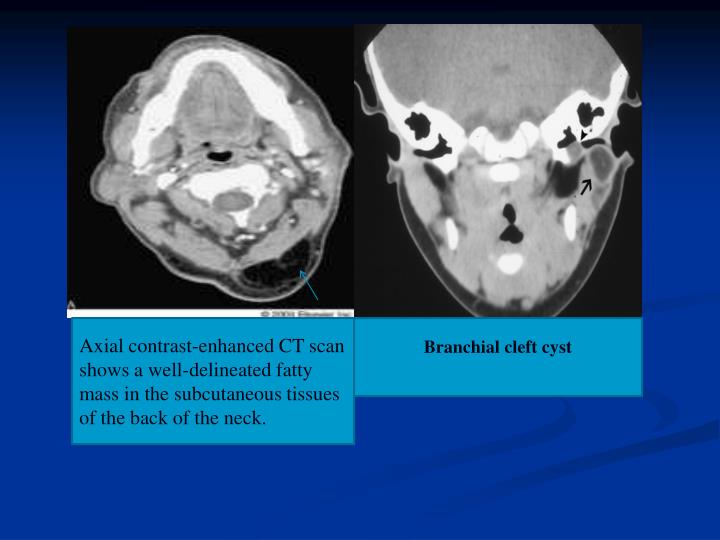 PPT - Branchial Cleft Cyst PowerPoint Presentation - ID:261469