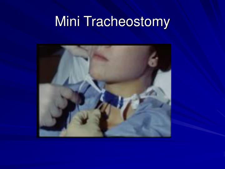 PPT - Tracheostomy Care PowerPoint Presentation - ID:262076
