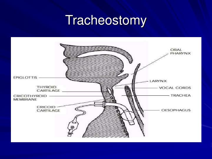 PPT - Tracheostomy Care PowerPoint Presentation - ID:262076