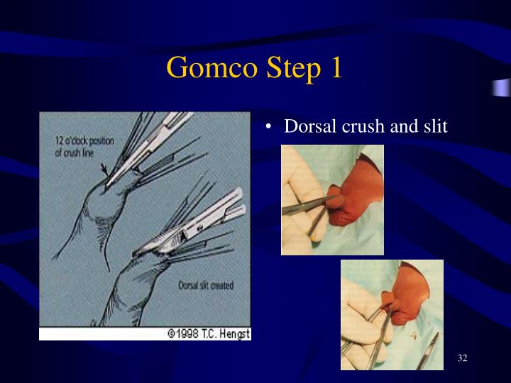 PPT - Neonatal Circumcision PowerPoint Presentation - ID:262163