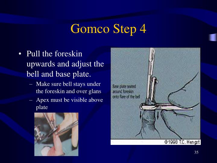 PPT - Neonatal Circumcision PowerPoint Presentation - ID:262163