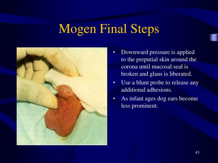 PPT - Neonatal Circumcision PowerPoint Presentation - ID:262163