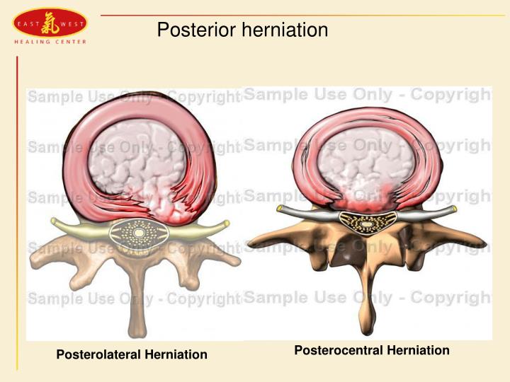 PPT - Pathology and TCM Treatment of the Herniated Lumbar Disc ...