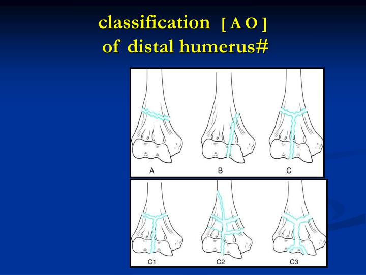 PPT - Fractures and dislocations around the elbow in adults PowerPoint ...
