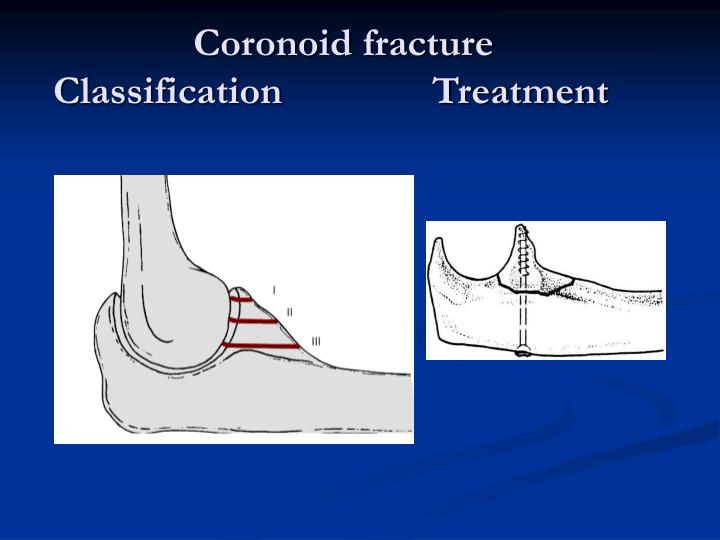 PPT - Fractures and dislocations around the elbow in adults PowerPoint ...