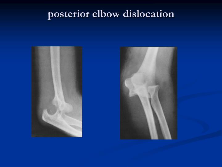 PPT - Fractures and dislocations around the elbow in adults PowerPoint ...