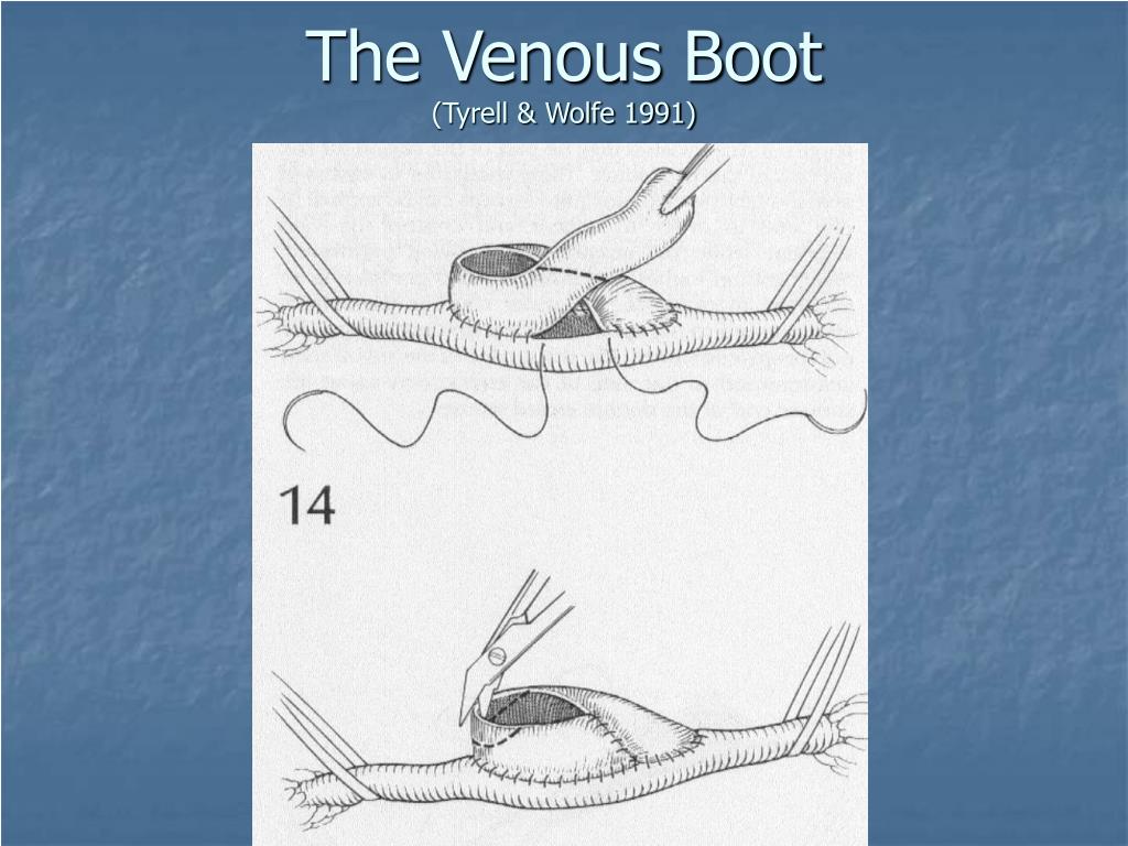 PPT - Early results of a prospective trial of spliced vein vs PTFE ...