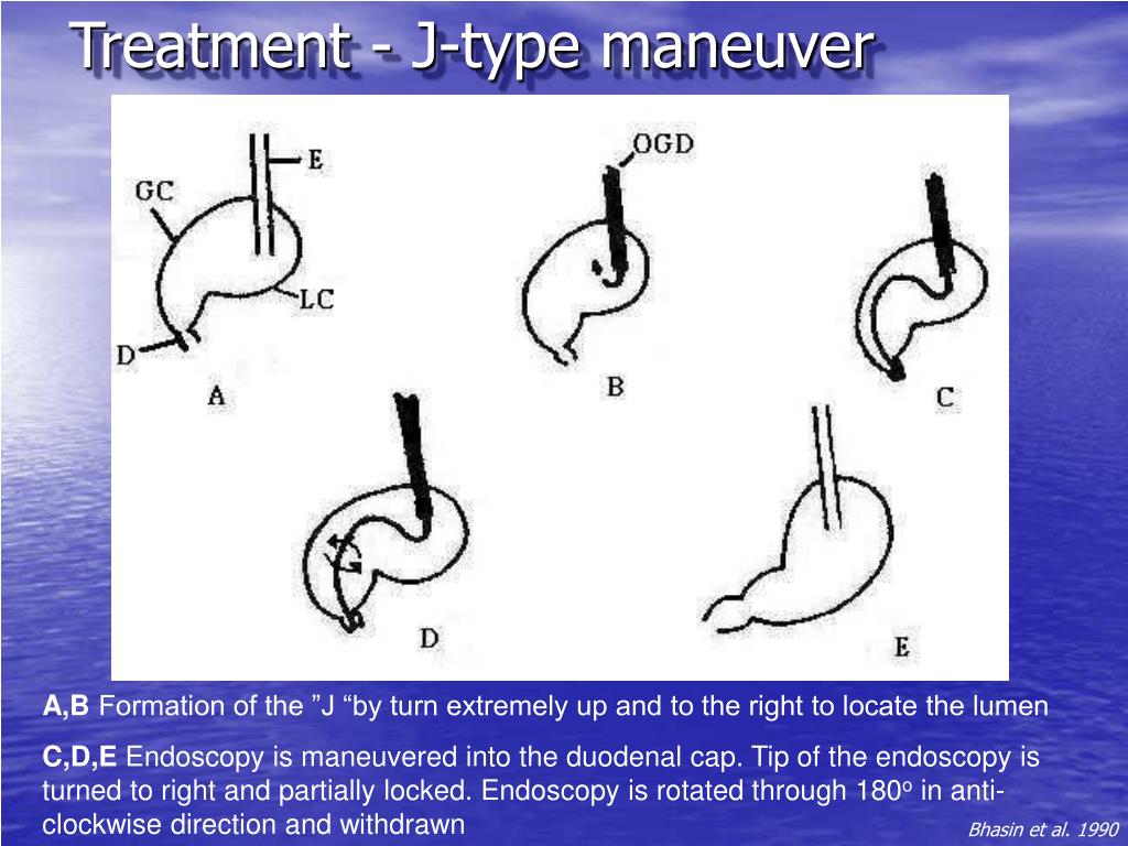PPT - Joint Hospital Grand Round Management of Chronic Gastric Volvulus ...