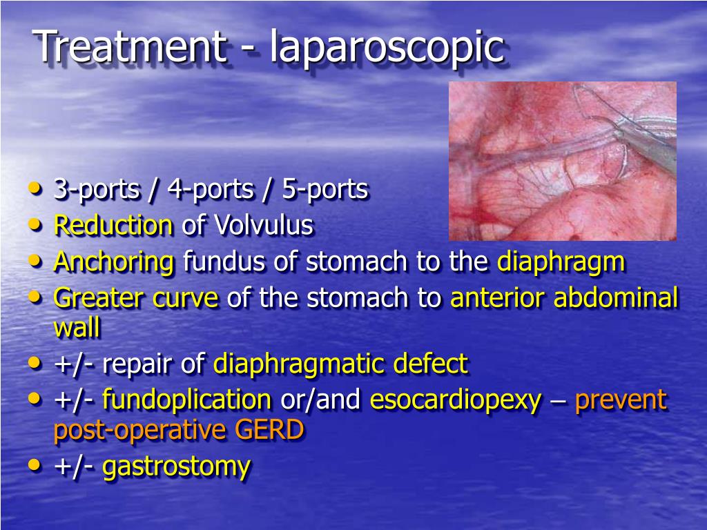PPT - Joint Hospital Grand Round Management of Chronic Gastric Volvulus ...