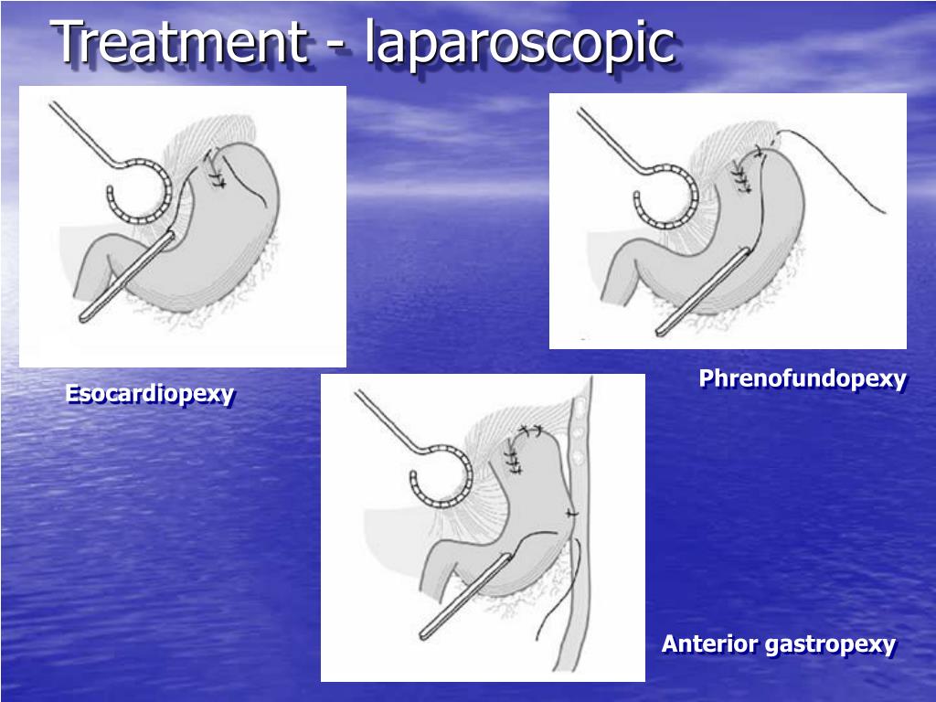 PPT - Joint Hospital Grand Round Management of Chronic Gastric Volvulus ...