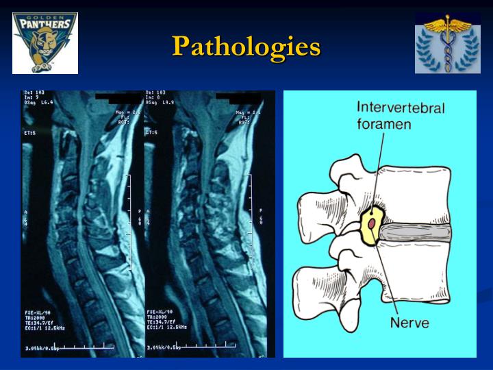 PPT - Cervical Spine Pathologies and Special Tests PowerPoint ...