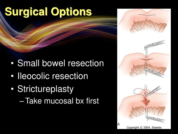 PPT - Small Bowel PowerPoint Presentation - ID:272078