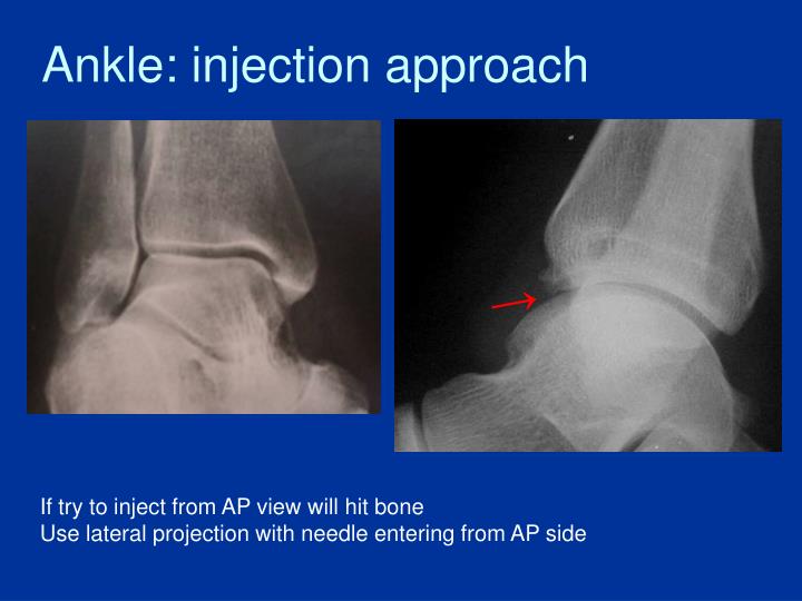 PPT - Basic Joint Injection “How to do it” PowerPoint Presentation - ID ...