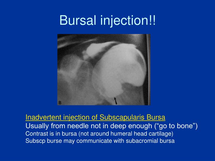 PPT - Basic Joint Injection “How to do it” PowerPoint Presentation - ID ...