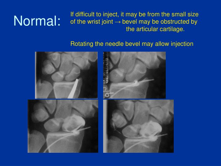 PPT - Basic Joint Injection “How to do it” PowerPoint Presentation - ID ...