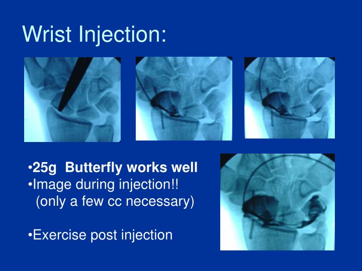 PPT - Basic Joint Injection “How to do it” PowerPoint Presentation - ID ...