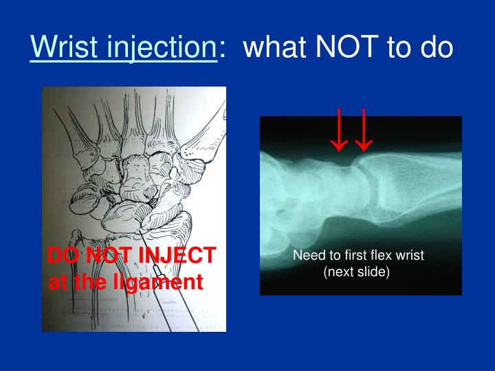 PPT - Basic Joint Injection “How to do it” PowerPoint Presentation - ID ...