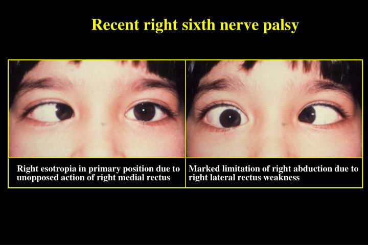 PPT - OCULAR MOTOR NERVE PALSIES PowerPoint Presentation - ID:274793