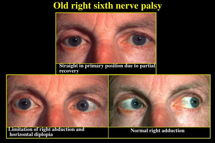PPT - OCULAR MOTOR NERVE PALSIES PowerPoint Presentation - ID:274793