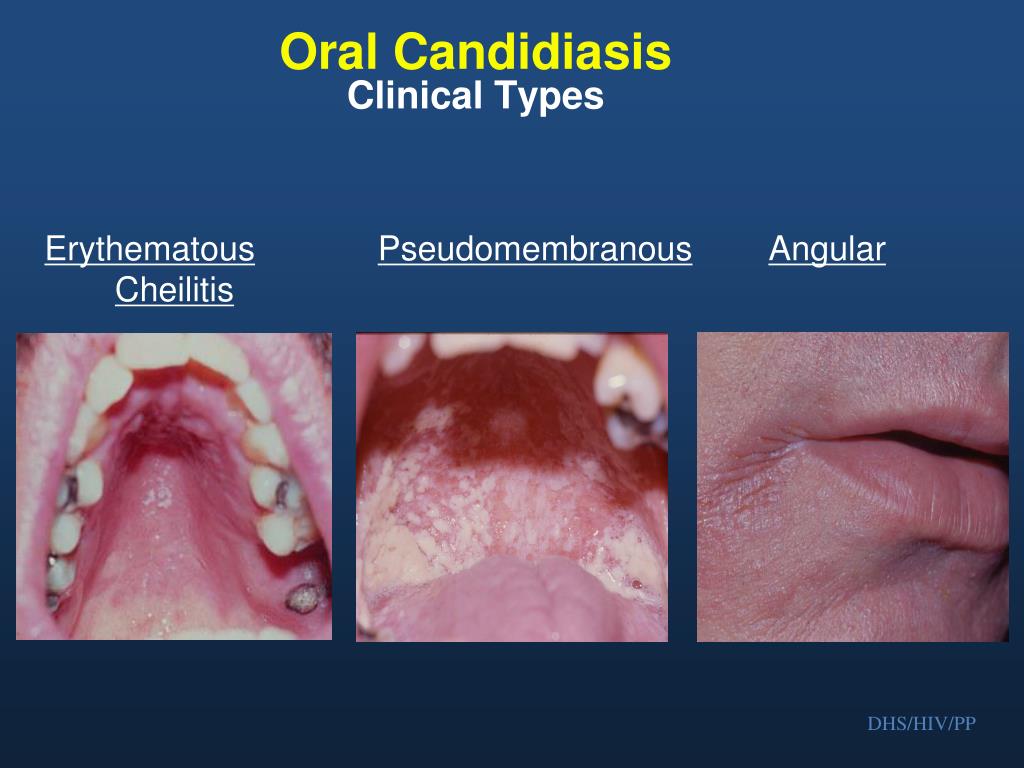 Candidiasis Cutaneous Oral And Other Types