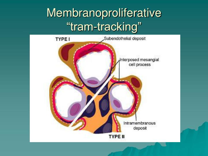 PPT - Glomerulonephritis PowerPoint Presentation - ID:282168