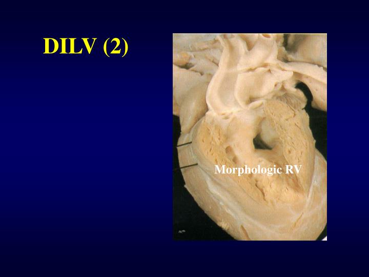 PPT - Double Inlet Ventricle PowerPoint Presentation - ID:282508